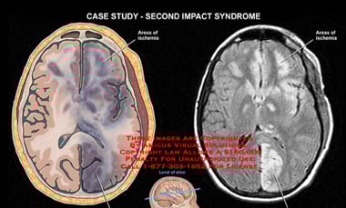 The Dangers and Prognosis of Second-Impact Syndrome