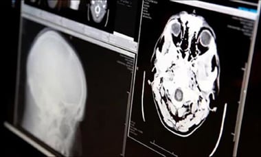 Traumatic Brain Injury (TBI) Assessment Tools